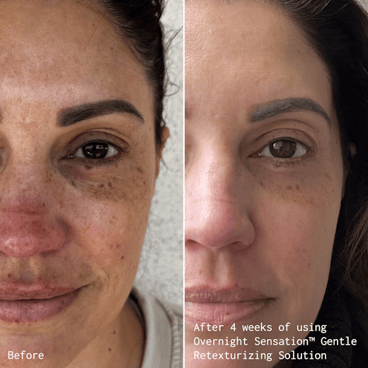 Overnight Sensation™ Gentle Retexturizing Solution