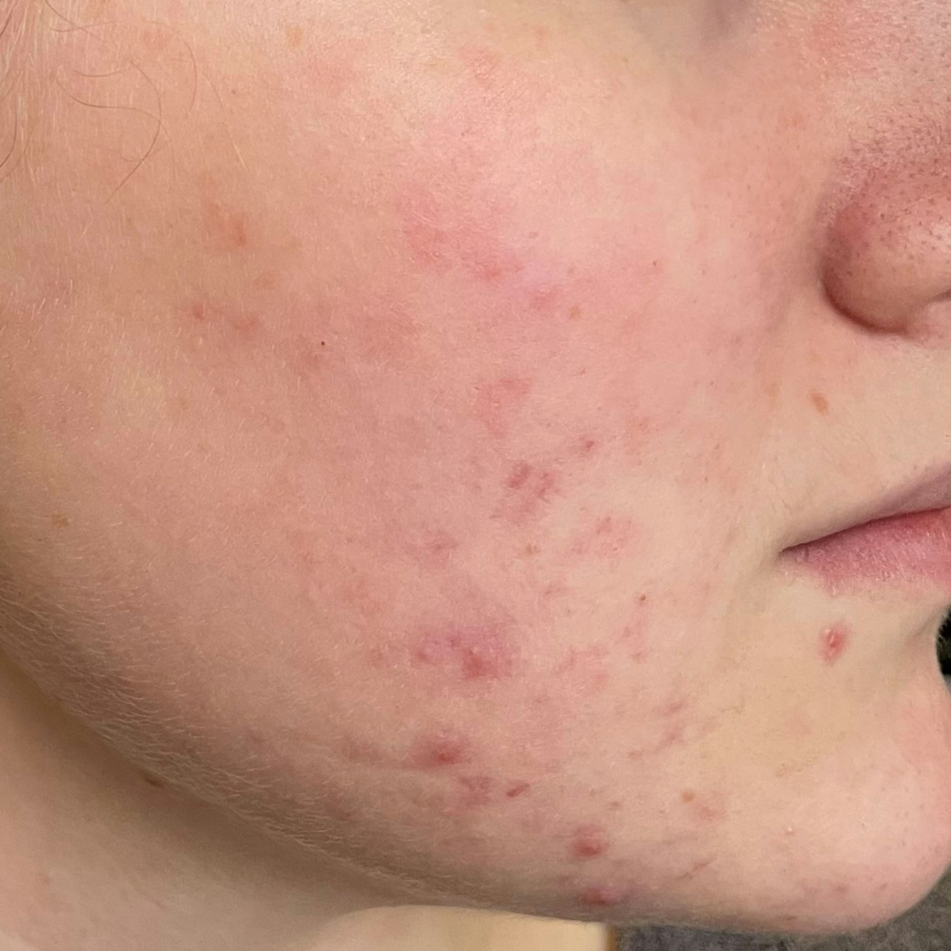 Expert Regimens for Blemished Skin | Save 10%